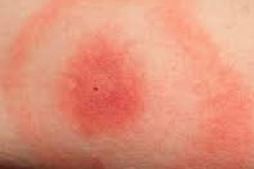 Attention aux tiques lors de vos balades en forêt | Conteville - Eure ...